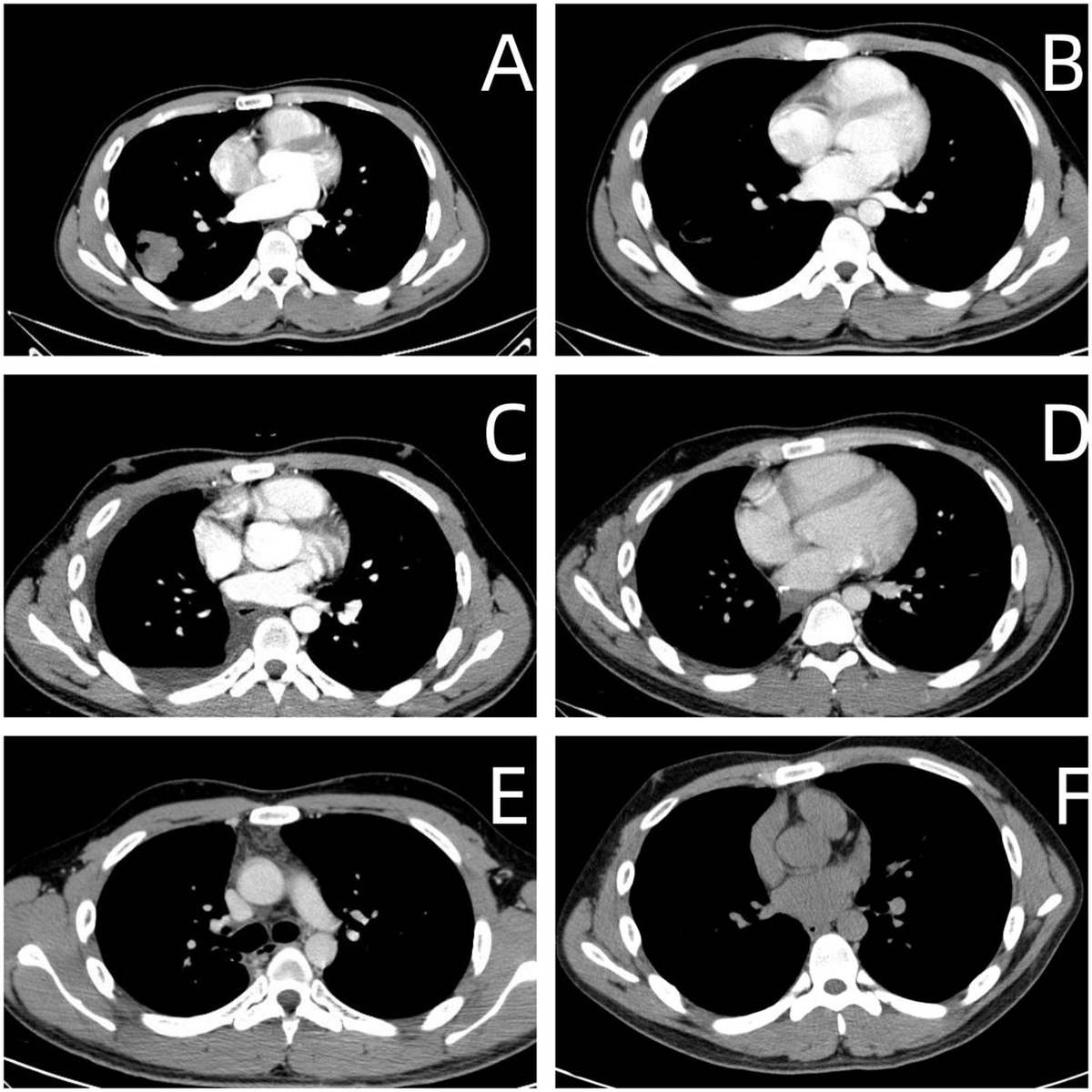 Frontiers A Case Report Of Recurrent Testicular Germ Cell Tumor In A
