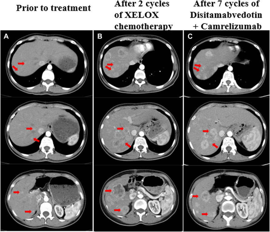 Frontiers Case Report Remarkable Response To Later Line Surufatinib