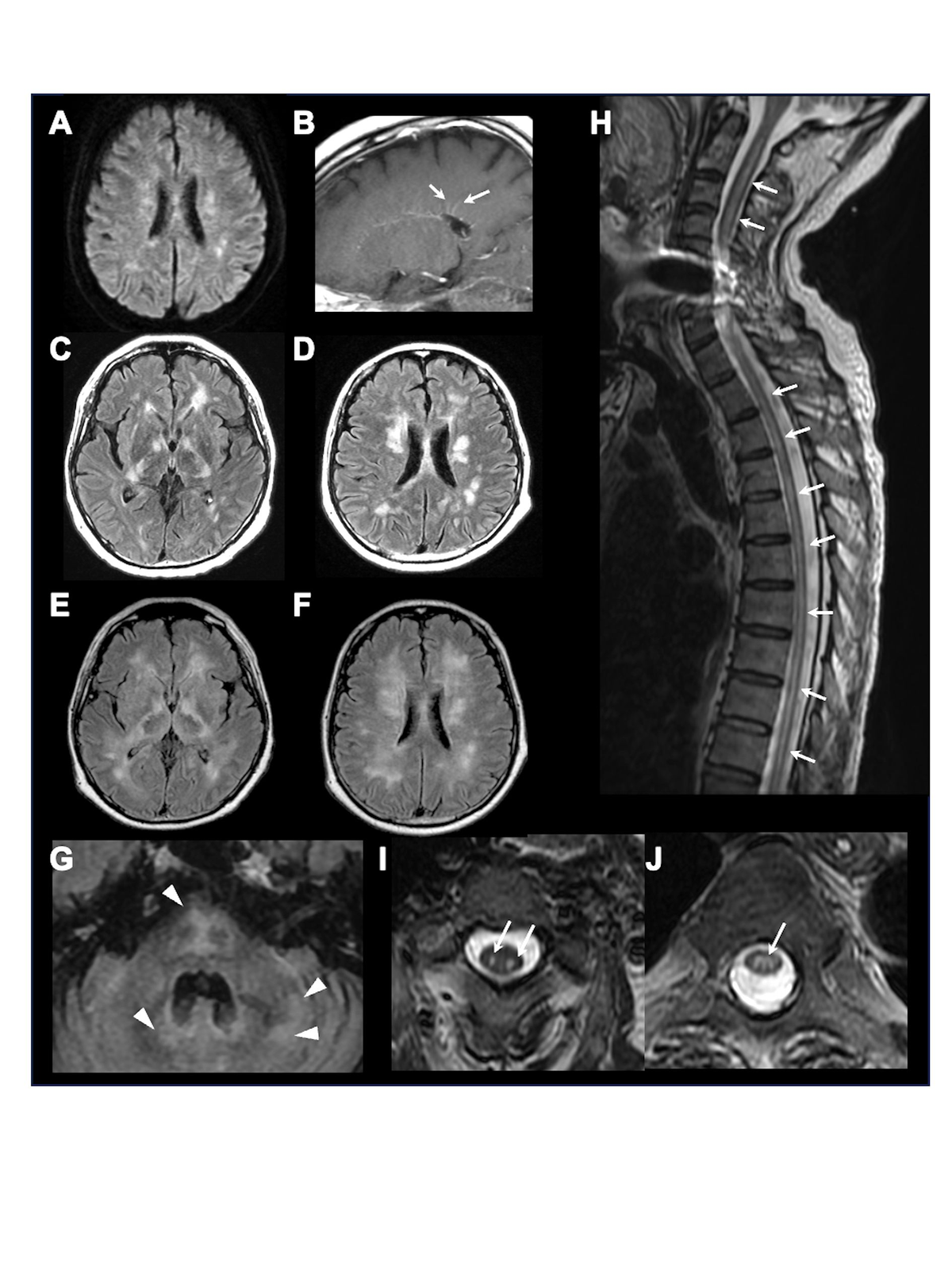Frontiers | Case report: Atypical case of autoimmune glial fibrillary ...