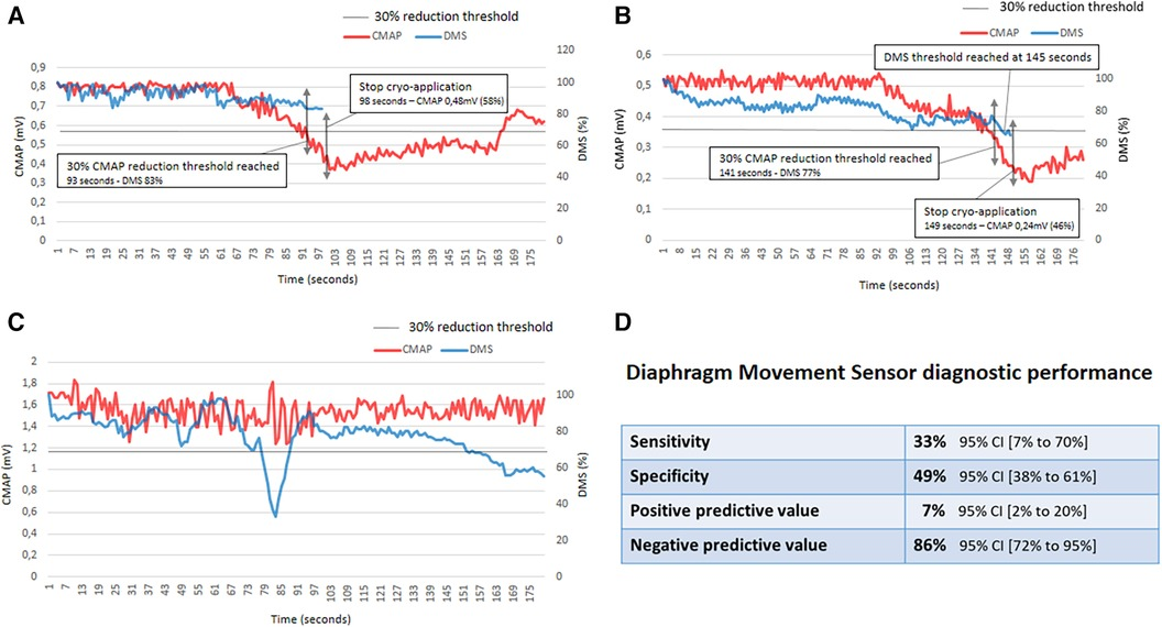 Frontiers | Diaphragm movement sensor for phrenic nerve monitoring ...