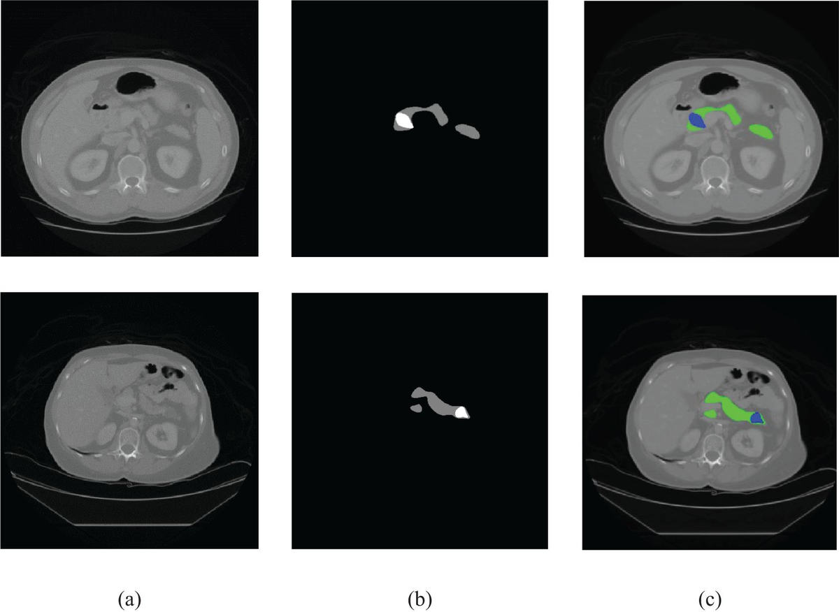 Frontiers | Weakly supervised large-scale pancreatic cancer Frontiers | Weakly supervised large-scale pancreatic cancer