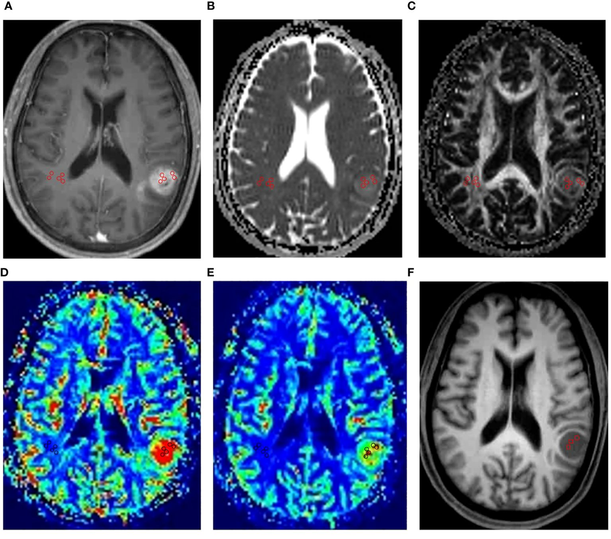 Frontiers | Noninvasive assessment of Ki-67 labeling index in glioma ...