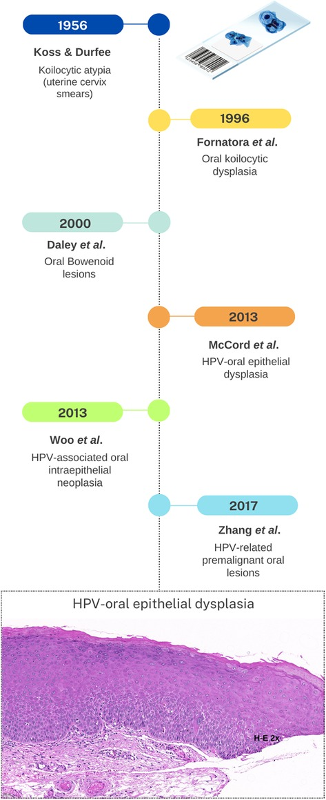 Frontiers | Oral HPV-associated dysplasia: is koilocytic dysplasia a ...