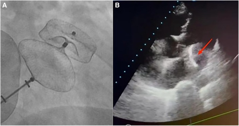 Frontiers | Case Report: Successful retrieval of a migrated left atrial ...