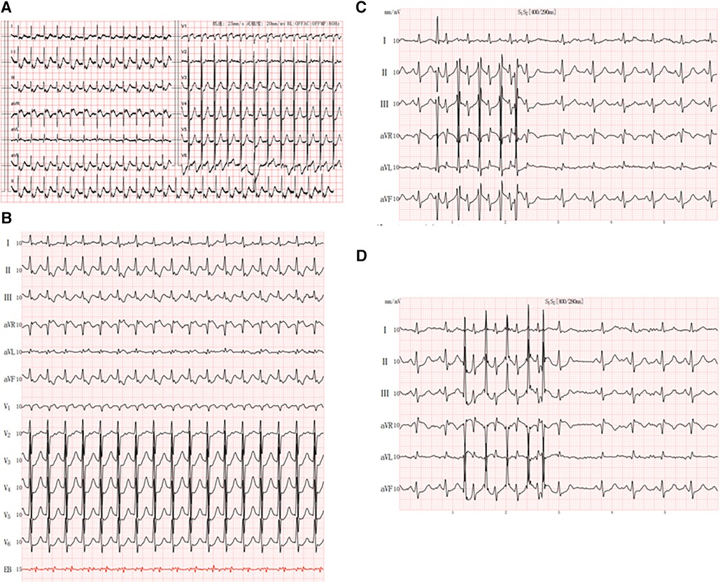Frontiers | Atrioventricular re-entrant tachycardia and ...