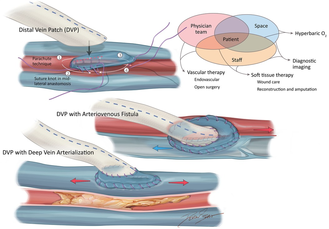 Frontiers | Management of peripheral arterial disease in the context of ...