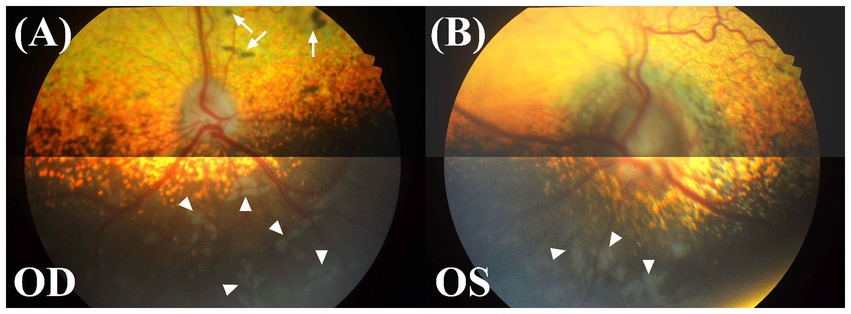 Frontiers | Case report: Unilateral papilledema in a dog with a large ...