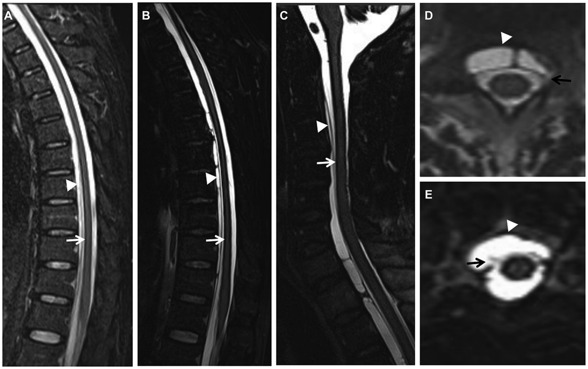 Frontiers | Infratentorial superficial siderosis: report of six cases ...