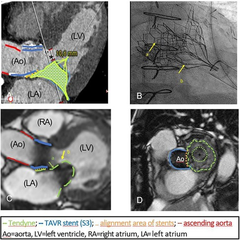 Frontiers | TMVR after TA-TAVR: a re-redo surgery—case report