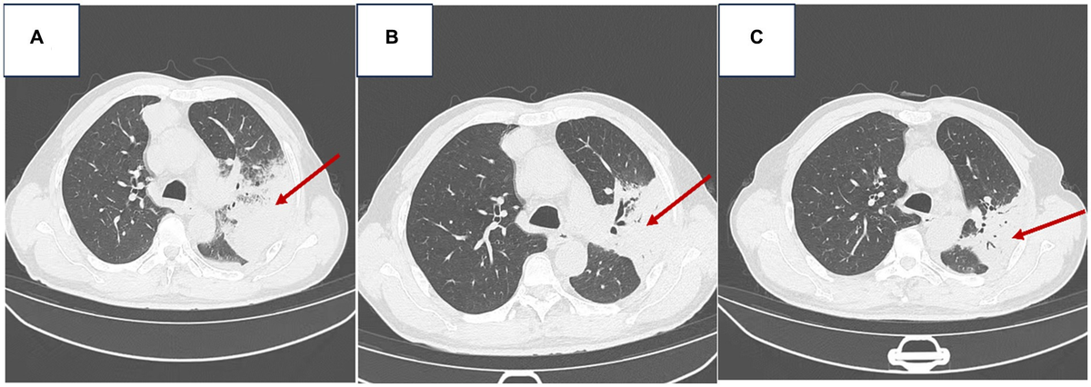 Frontiers | Case report: A patient with HHV-6 and HHV-7 combined with ...