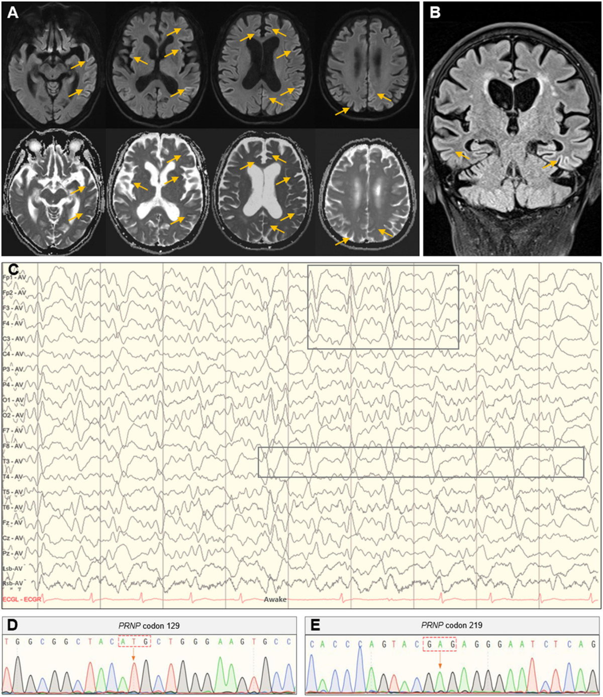 Frontiers | Multidimensional features of sporadic Creutzfeldt-Jakob ...