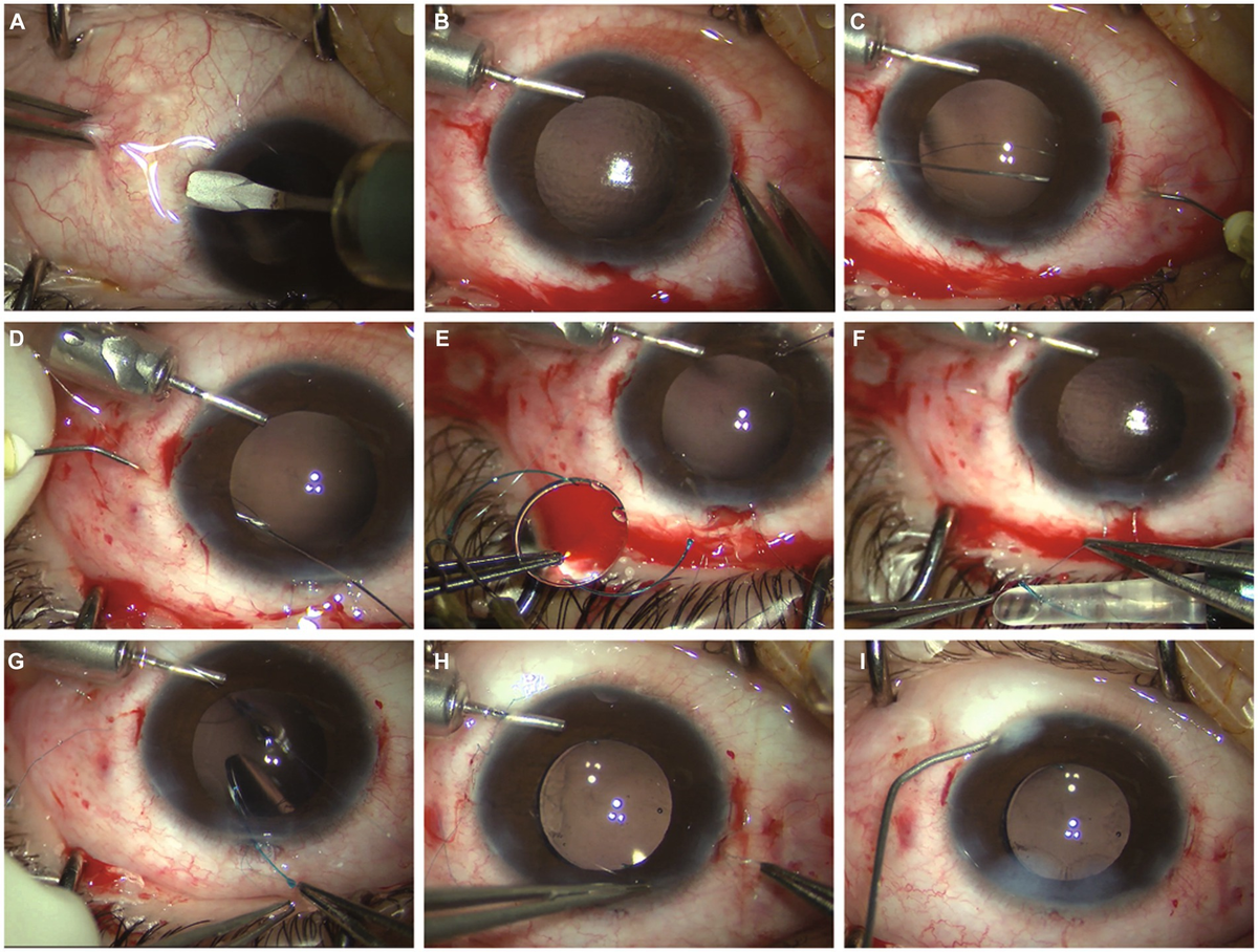 Frontiers | Clinical observation of a modified technique for ...