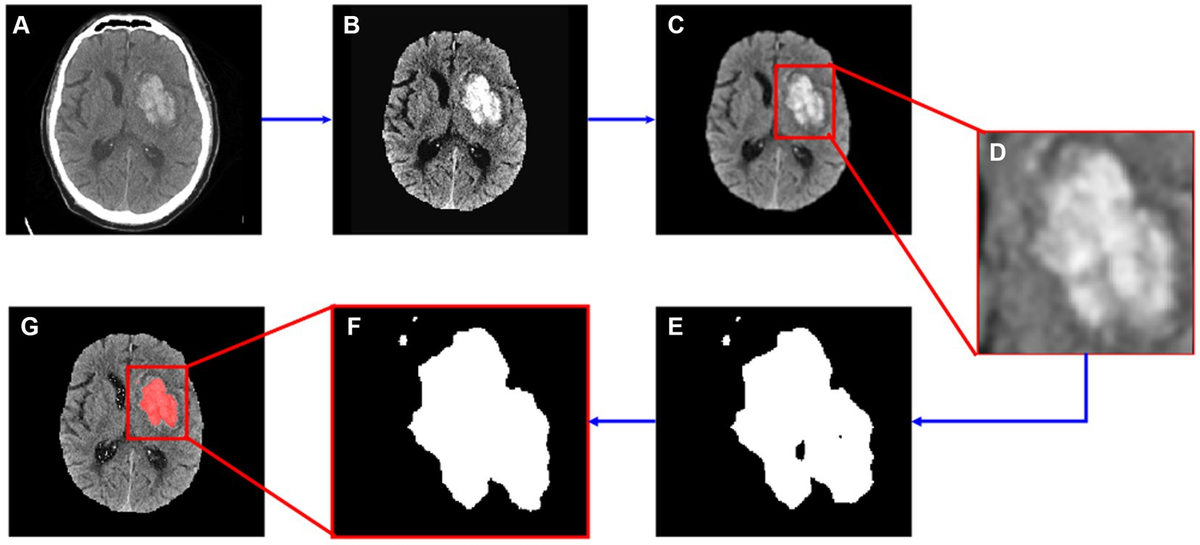 Frontiers | Automatic segmentation of hemorrhagic transformation on ...