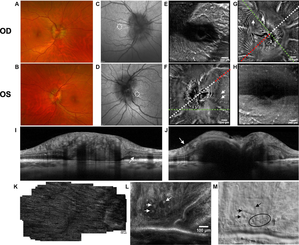 Frontiers | Application of novel non-invasive ophthalmic imaging to ...