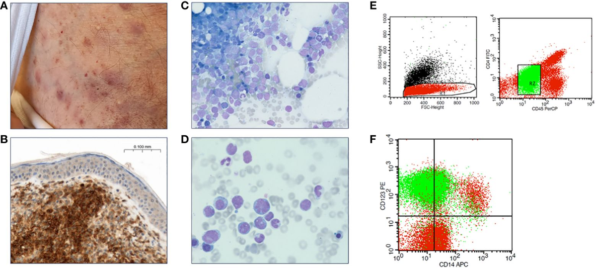 Frontiers | Real-world evidence on tagraxofusp for blastic plasmacytoid ...