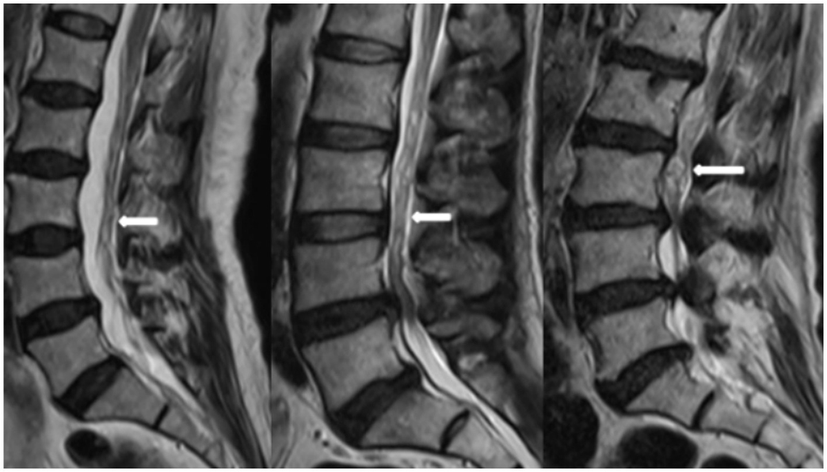 Frontiers | MRI parameters predict central lumbar spinal stenosis ...