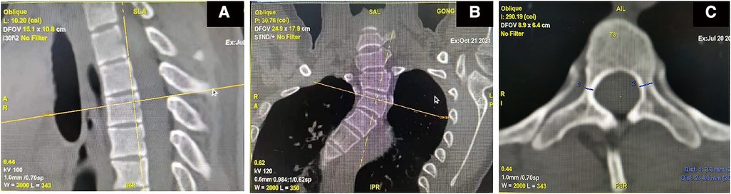 Frontiers | The application of gradually expanding pedicle technology ...