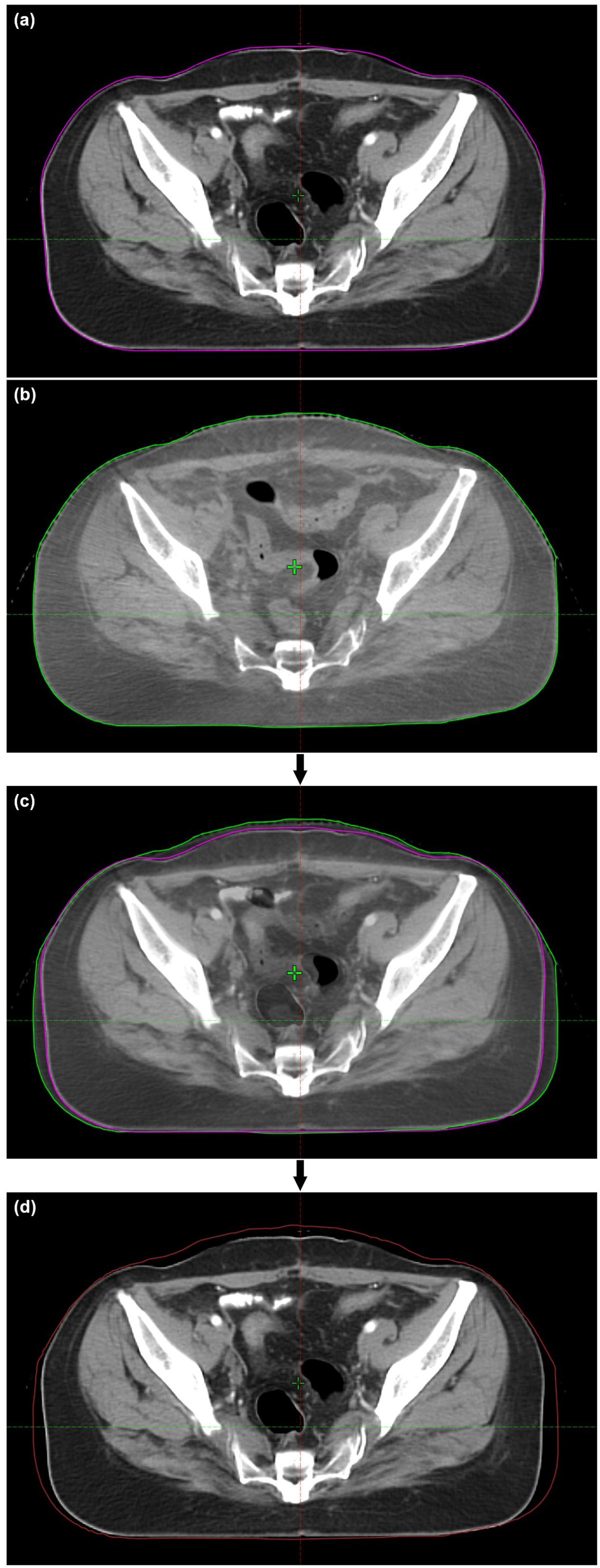 Frontiers | Effect of body contour changes on the setup and dosimetric ...