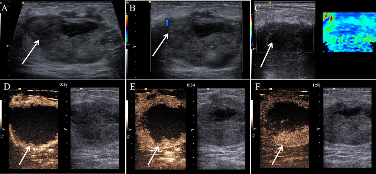 Frontiers | Malignant glomus tumor of the breast: a case report