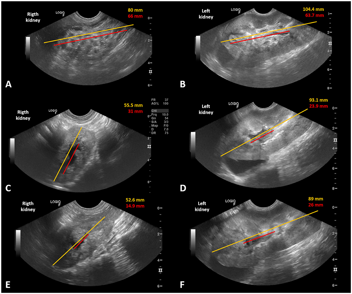 Frontiers | Case report: Is bilateral renal dioctophymosis and severe ...