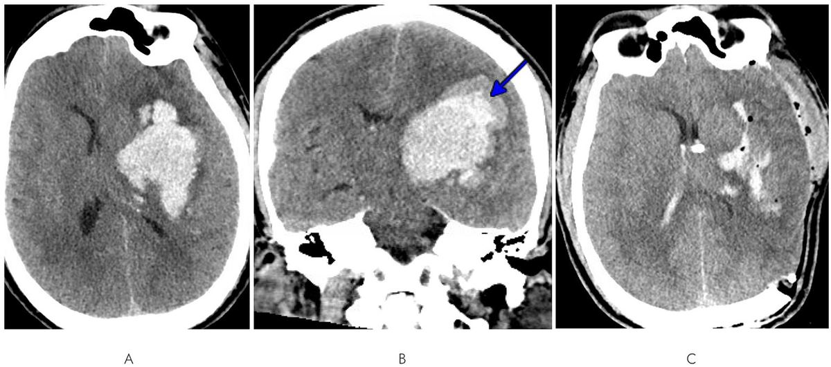 Frontiers | A review of methamphetamine use and stroke in the young