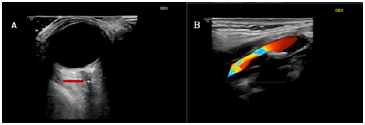Frontiers | Central retinal artery occlusion or retinal stroke: a ...