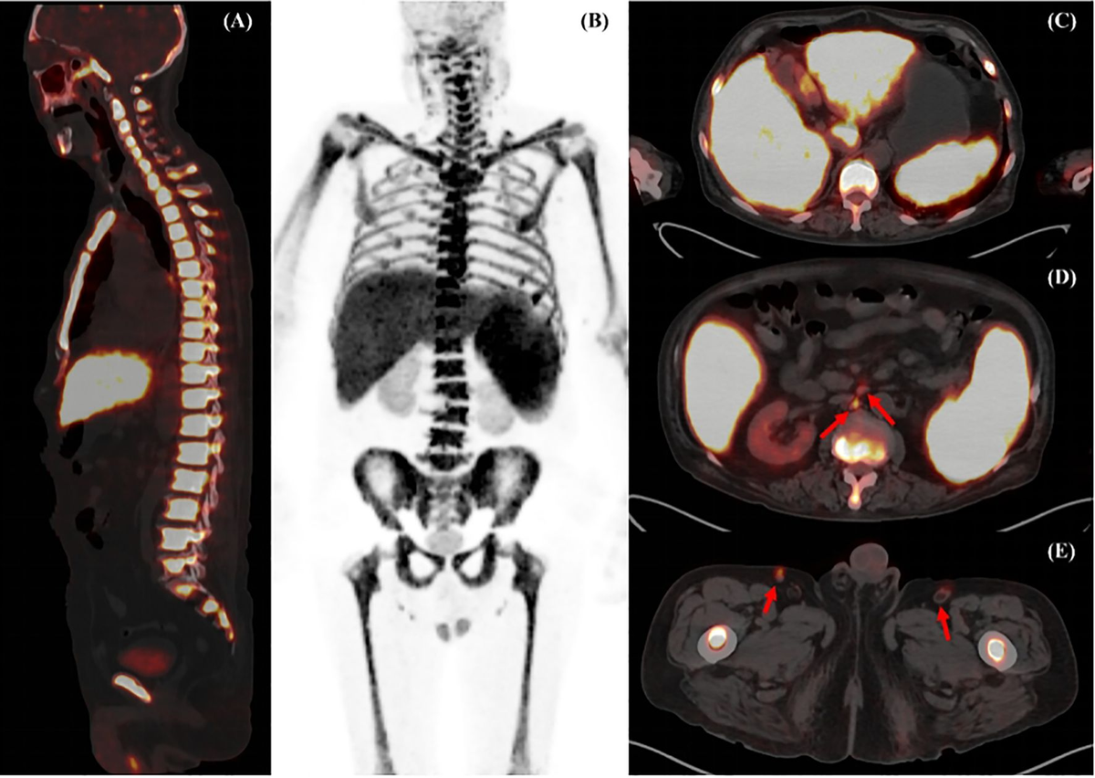 Frontiers | Case report: 18F-FDG PET/CT skeletal superscan-like in an ...