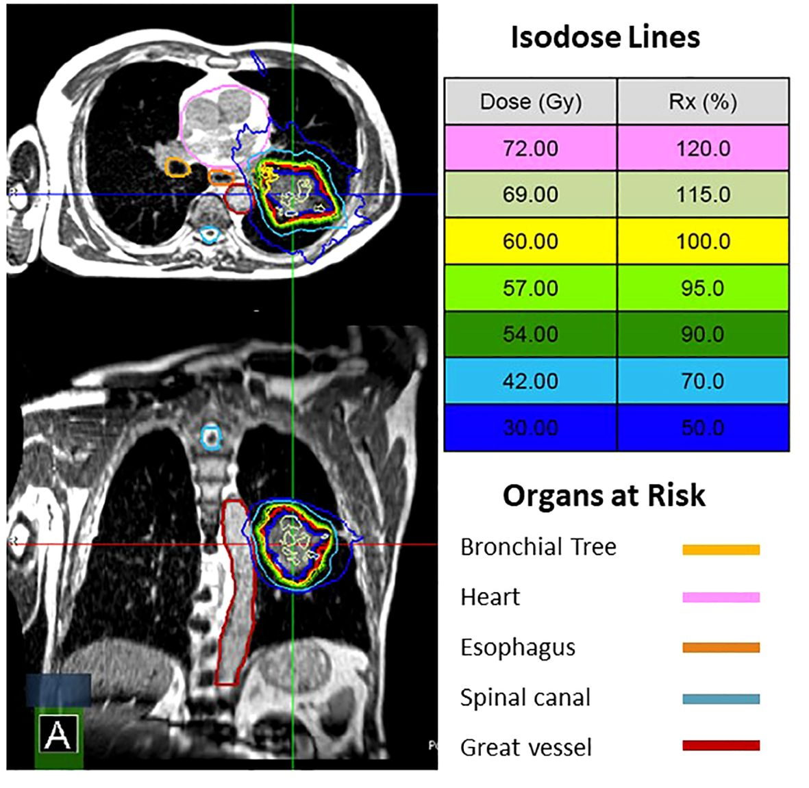Frontiers | Single institution experience of MRI-guided radiotherapy ...