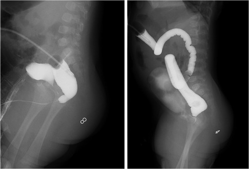 Frontiers | Laparoscopic-assisted distal colon excision and proximal ...