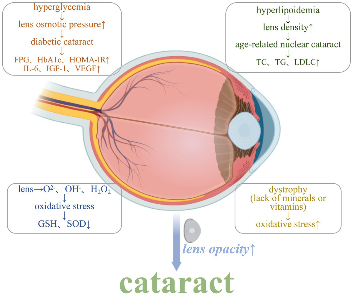 Frontiers | Research progress on the correlation between cataract ...