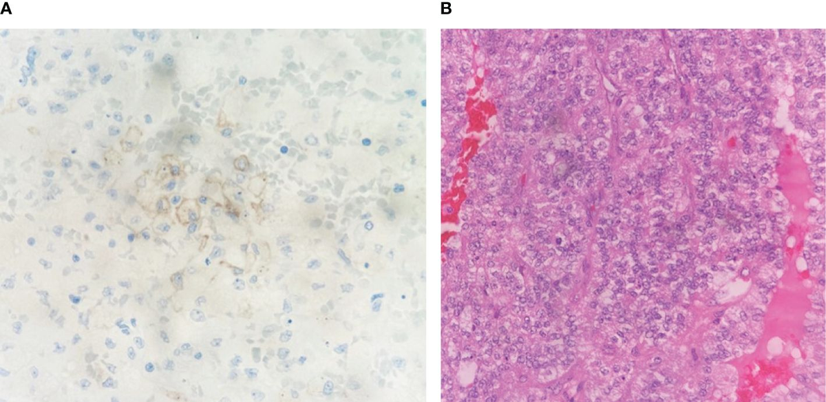 Frontiers | Case report: Ipilimumab and nivolumab in metastatic ...