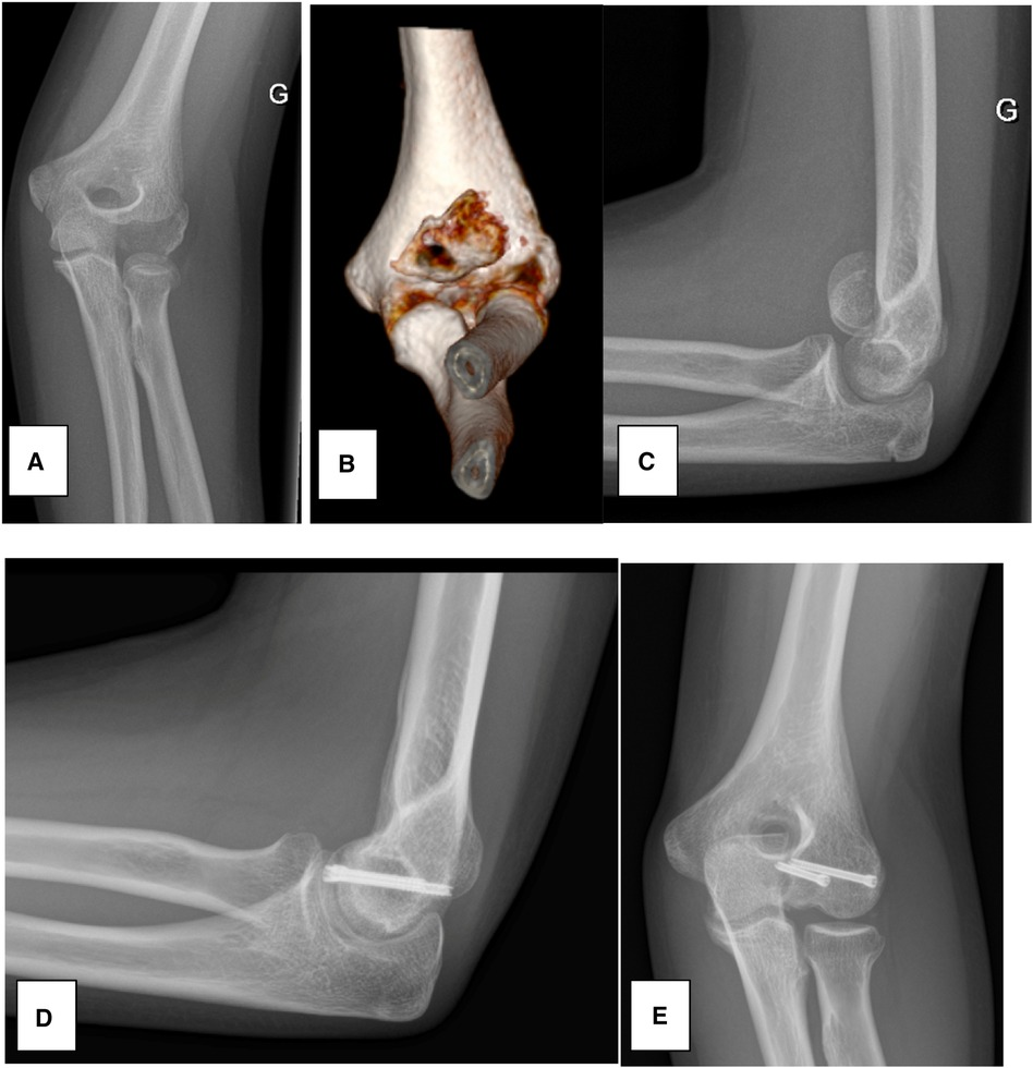 Frontiers | Shear fractures of the capitellum in children: a case ...