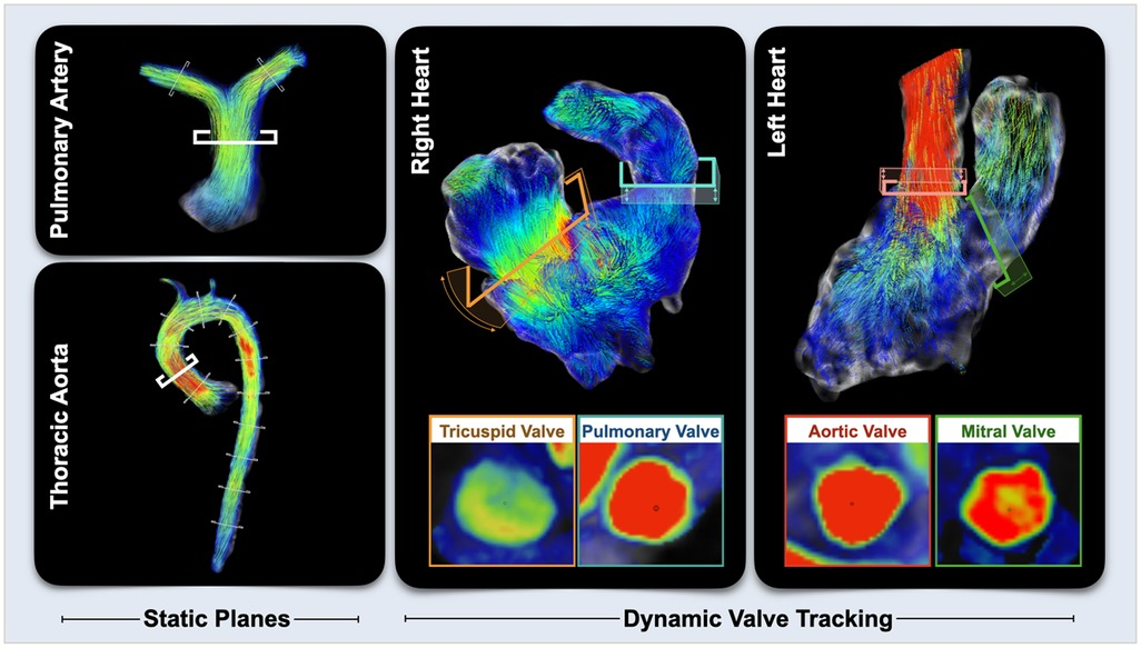 Frontiers | Direct comparison of whole heart quantifications between ...