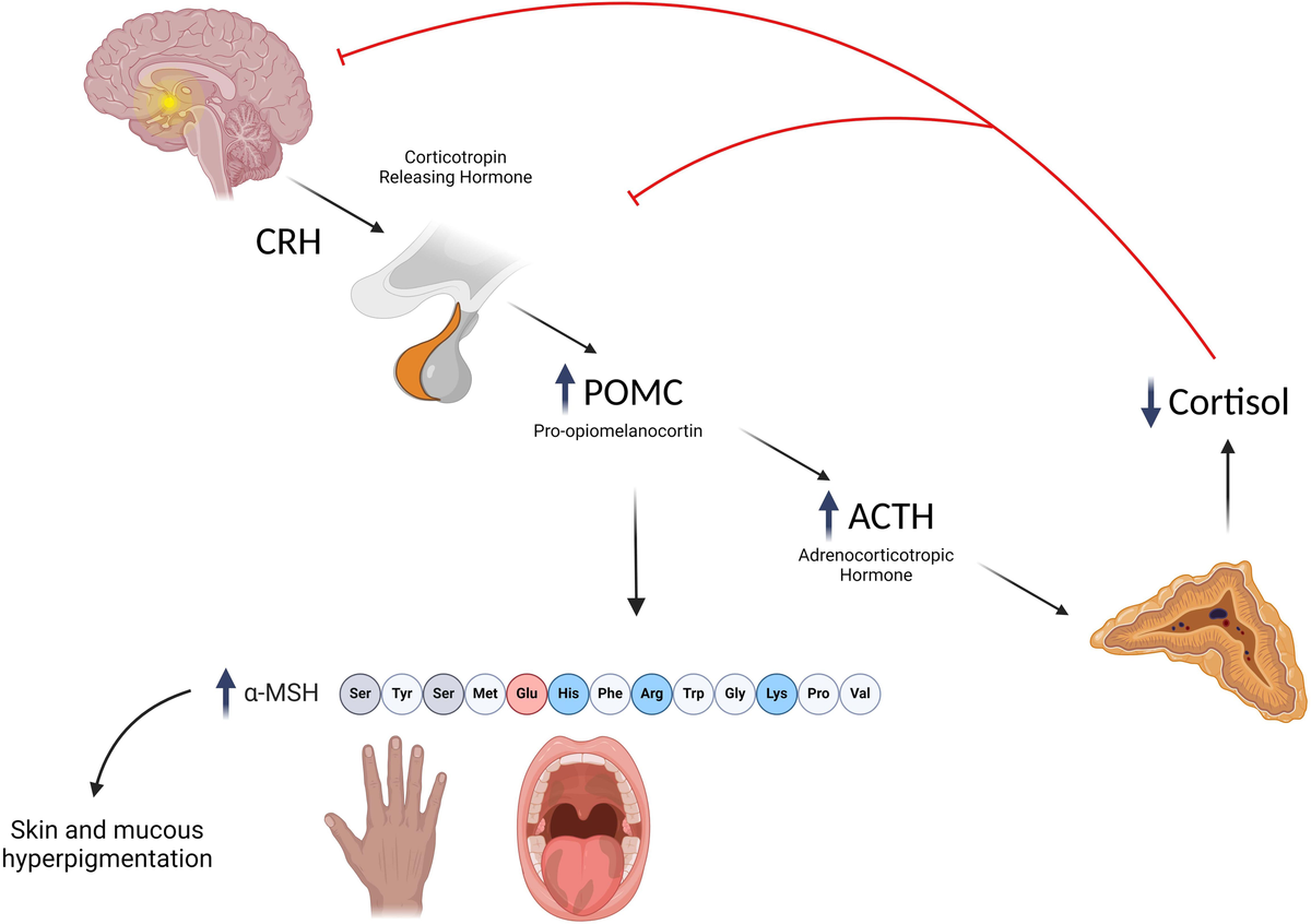 Frontiers | The multiple faces of autoimmune Addison’s disease in children
