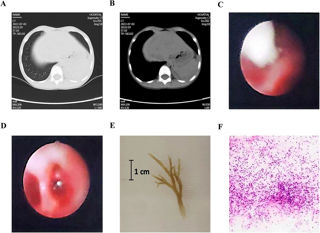 Frontiers | Risk factors for pleural effusion in children with plastic ...