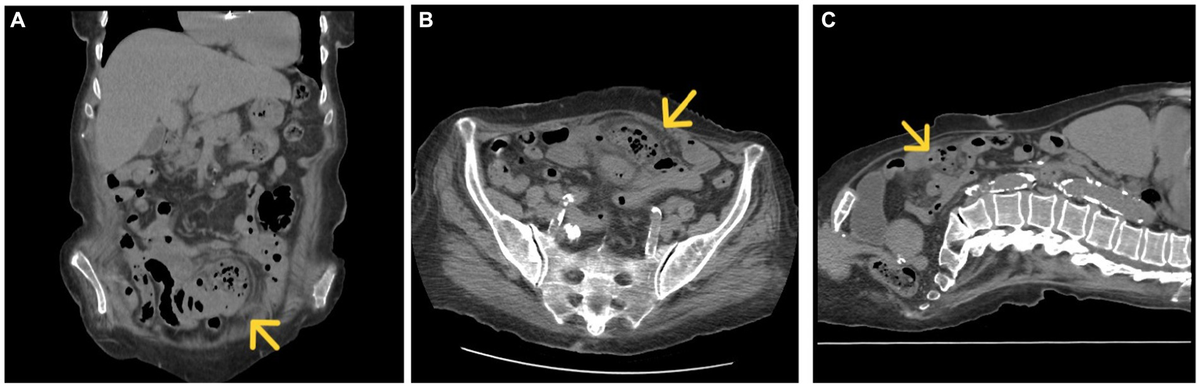 Frontiers | Acute complicated jejunum diverticulitis: a case report ...