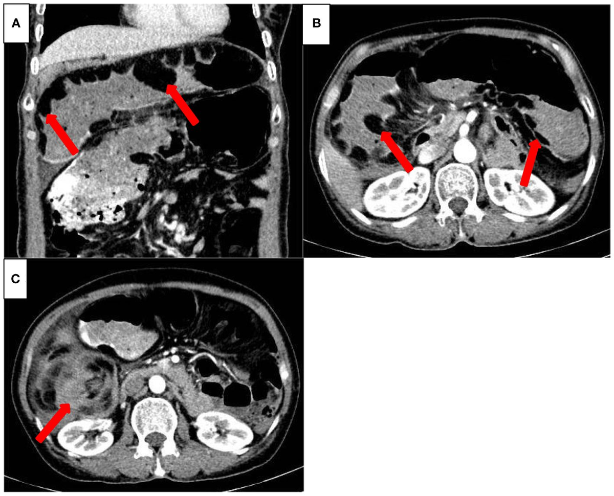 Frontiers | A case report of small intestinal volvulus caused by ...