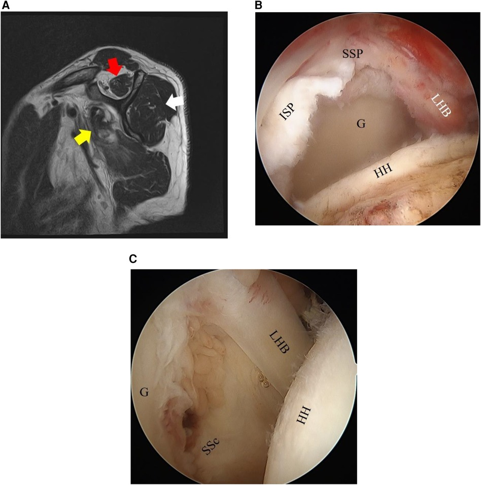 Frontiers | Associations between fatty infiltration of rotator cuff ...