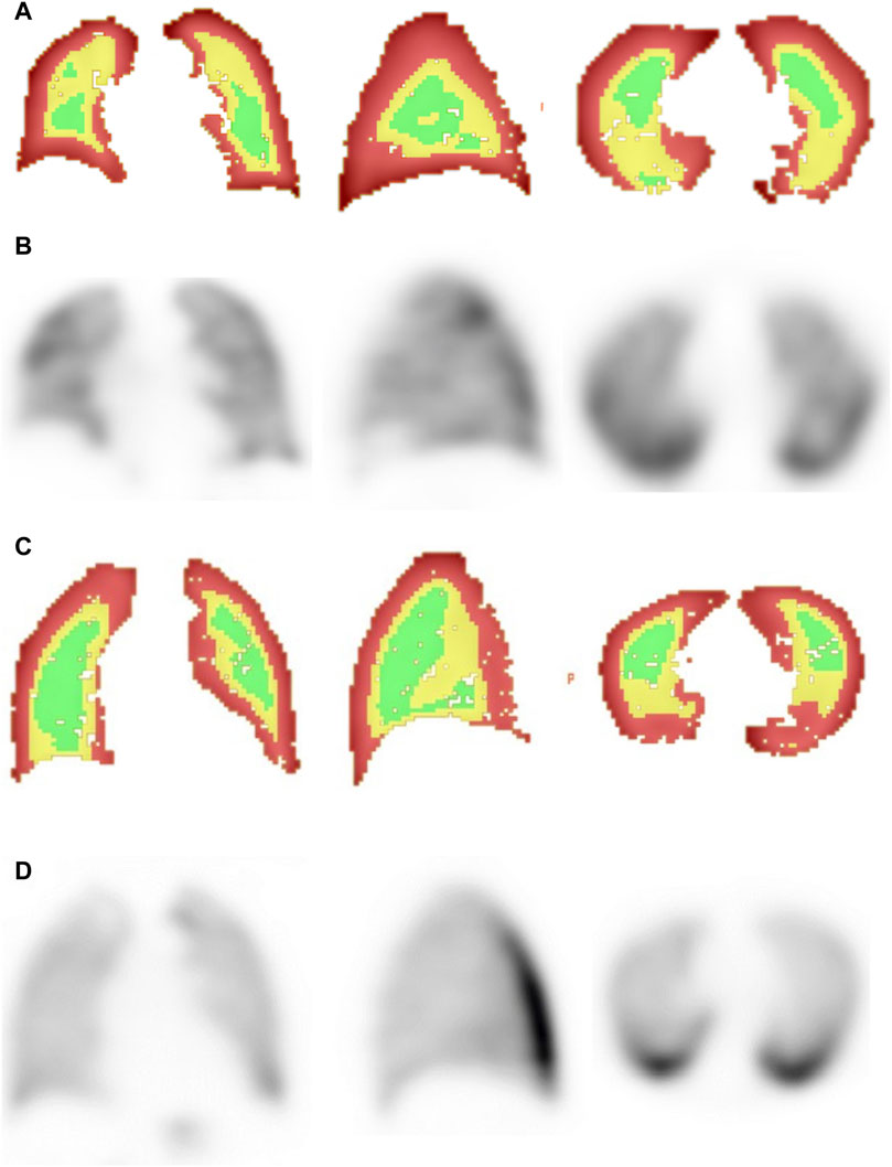 Frontiers | SPECT/CT to quantify early small airway disease and its ...