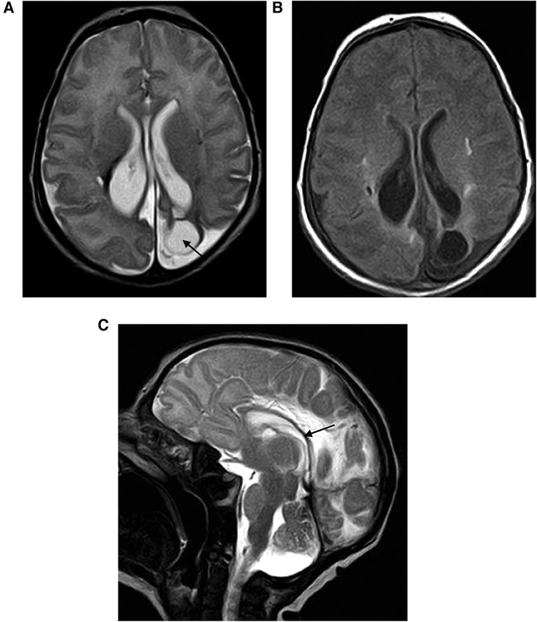 Frontiers | COL4A1 gene mutations and perinatal intracranial hemorrhage ...