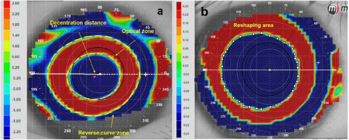 Frontiers | Analysis of corneal surface shape following overnight ...