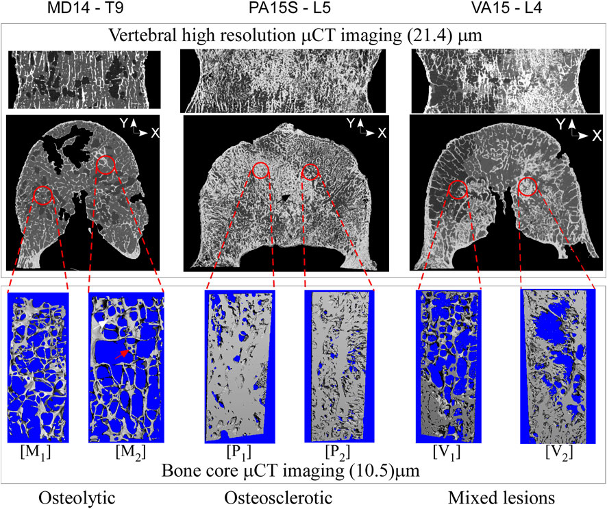 Frontiers | CT-based finite element simulating spatial bone damage accumulation predicts ...