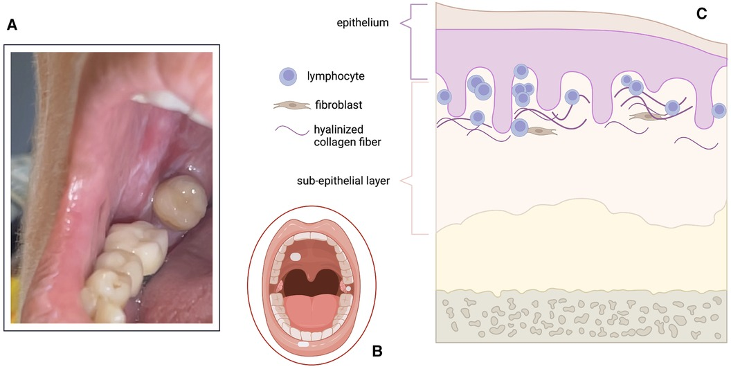 Frontiers Lichen Sclerosus Of The Oral Mucosa A Hidden Phenomenon