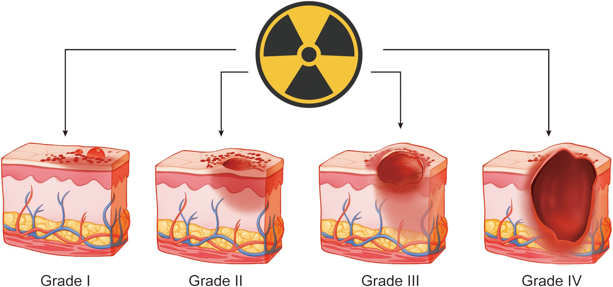 Frontiers | Global hotspots and research trends of radiation-induced ...