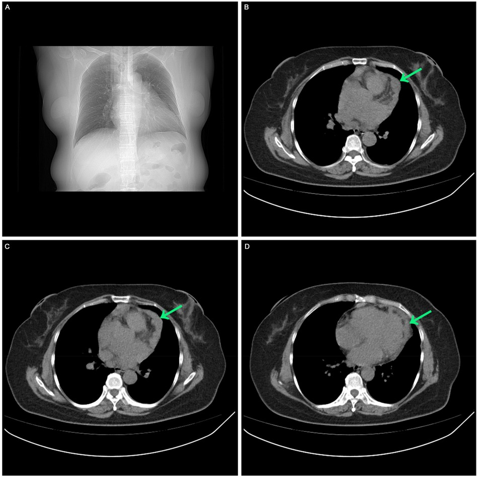 Frontiers | Case Report: A case of primary pericardial mesothelioma treated with multimodal ...