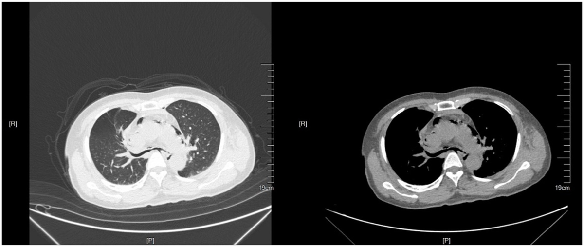 Frontiers | Partial rupture of the left main bronchus with left lung ...