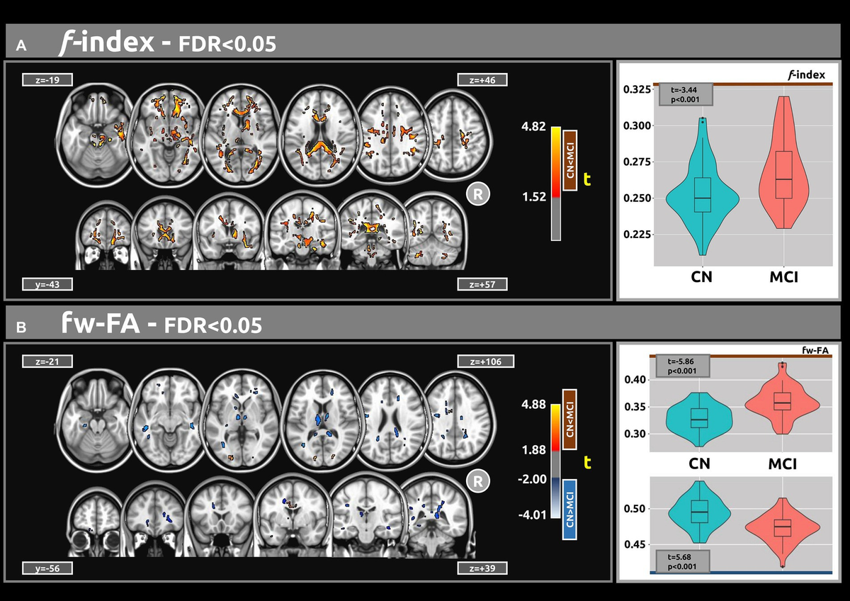 Frontiers | Exploring white matter microstructural alterations in mild cognitive impairment: a ...
