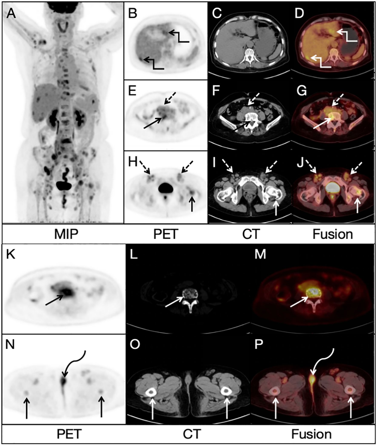 Frontiers | 18F-FDG PET/CT detection of primary mammary-like ...