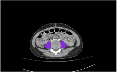 Frontiers | Pediatric reference values for total psoas muscle area in ...