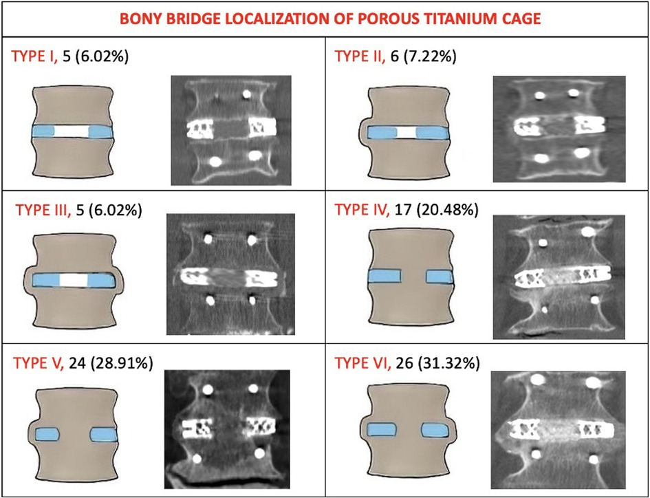 Frontiers | Radiological evaluation of fusion patterns after Lateral ...